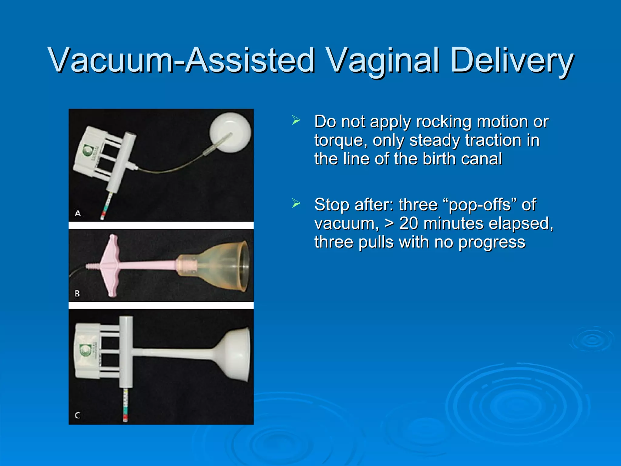 Teachingmoduleoperativevaginaldelivery | PPT