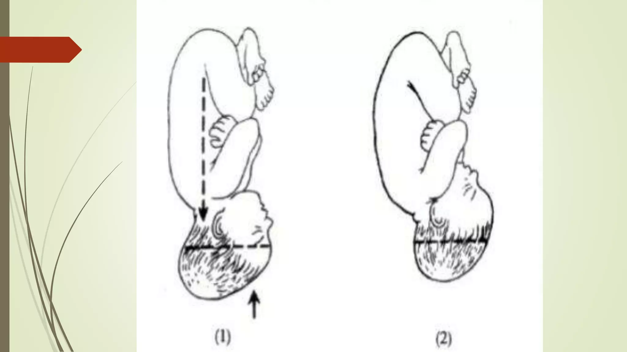 mechanism of labor | PPTX