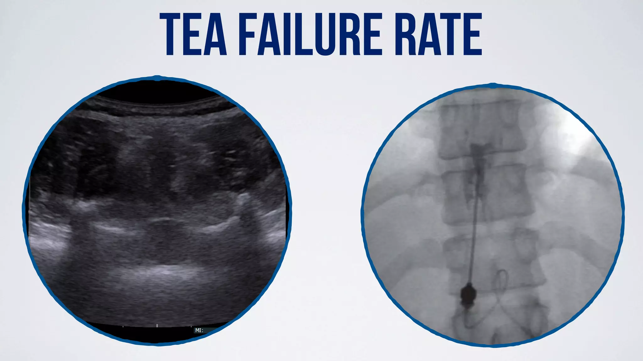 Thoracic Epidural Analgesia is the Preferred Analgesic Strategy for ...