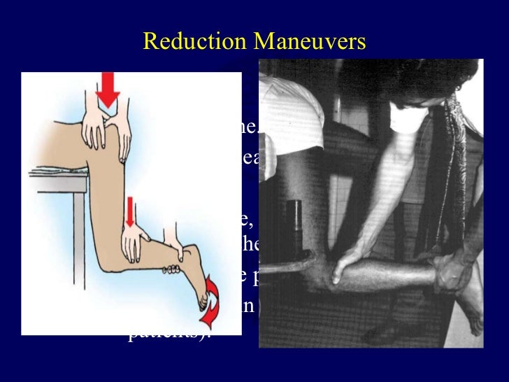 Management of Hip Dislocations