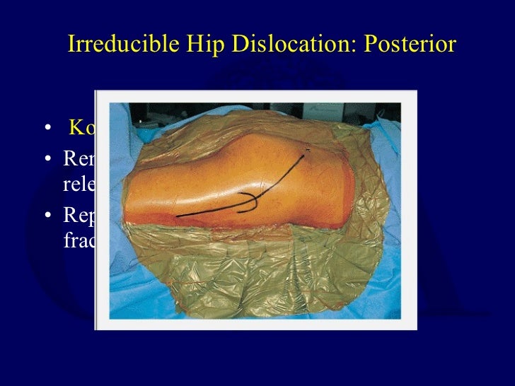 Management of Hip Dislocations