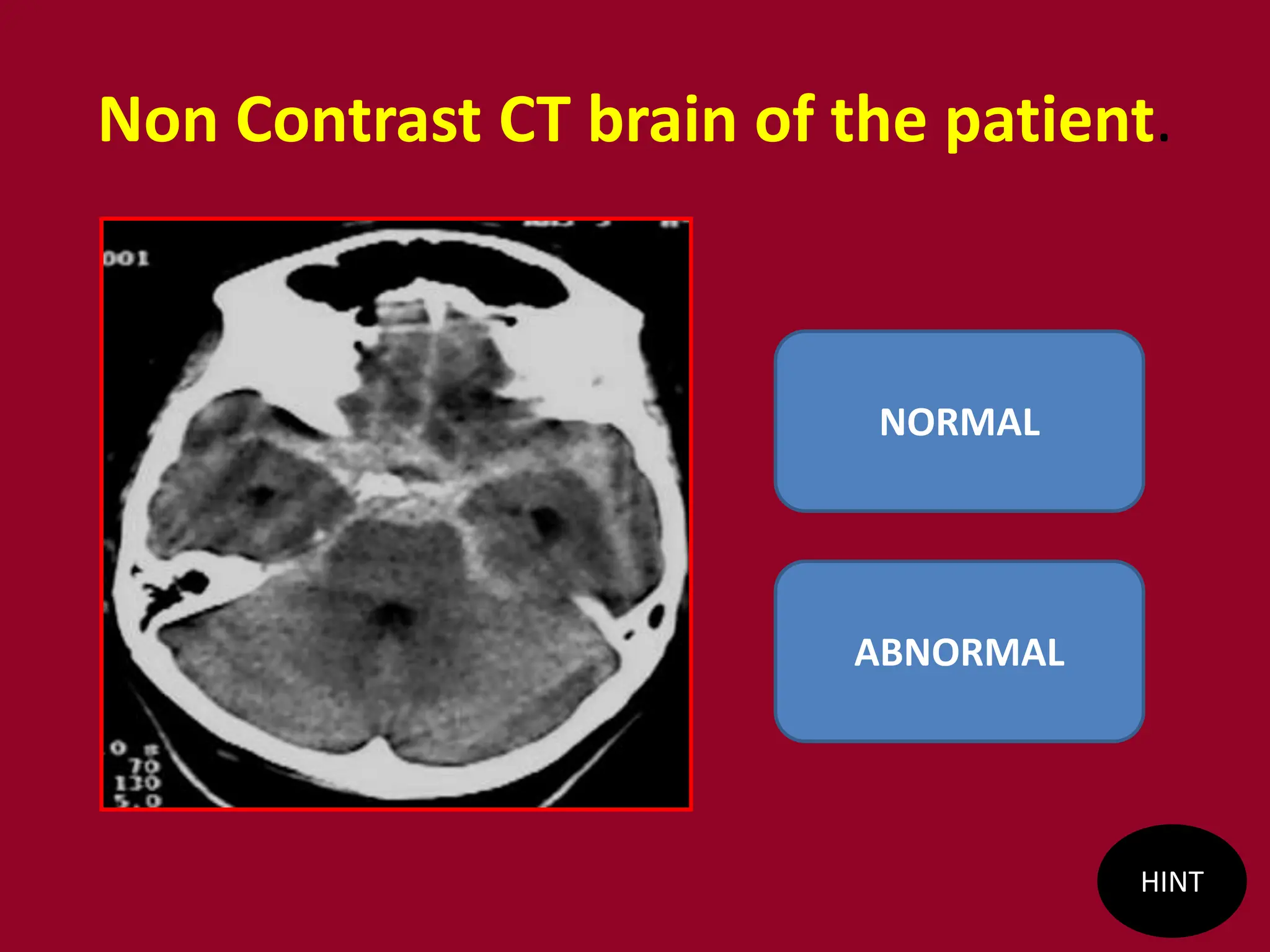 Subarachnoid Hemorrhage - Radiology | PPTX