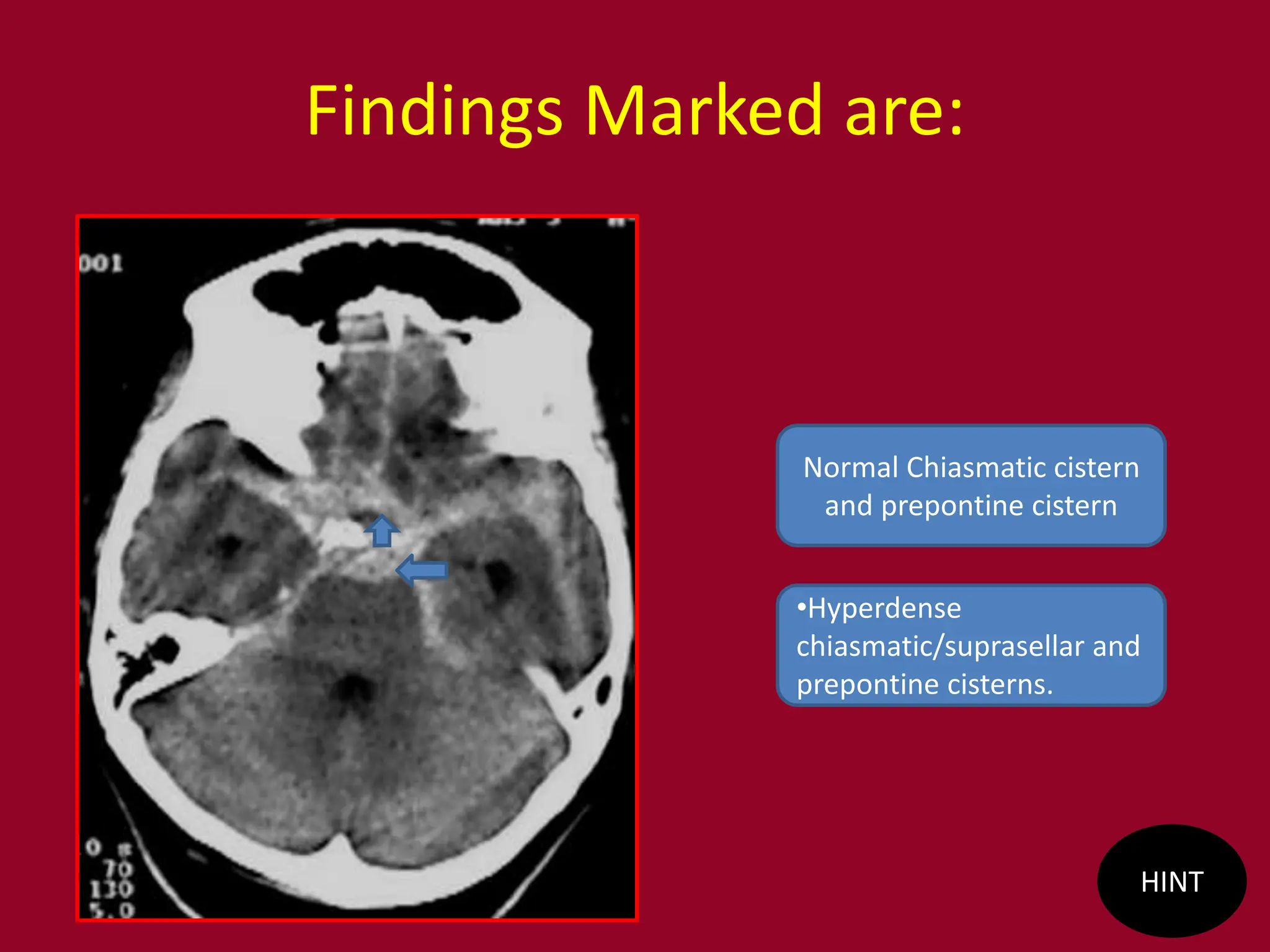 Subarachnoid Hemorrhage - Radiology | PPTX