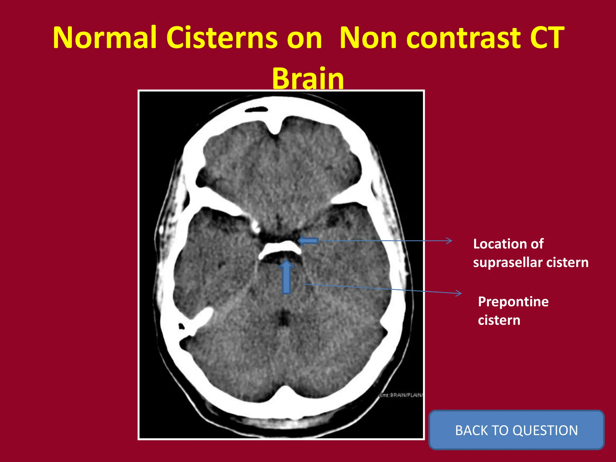 Subarachnoid Hemorrhage - Radiology | PPTX