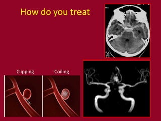 Subarachnoid Hemorrhage - Radiology | PPTX