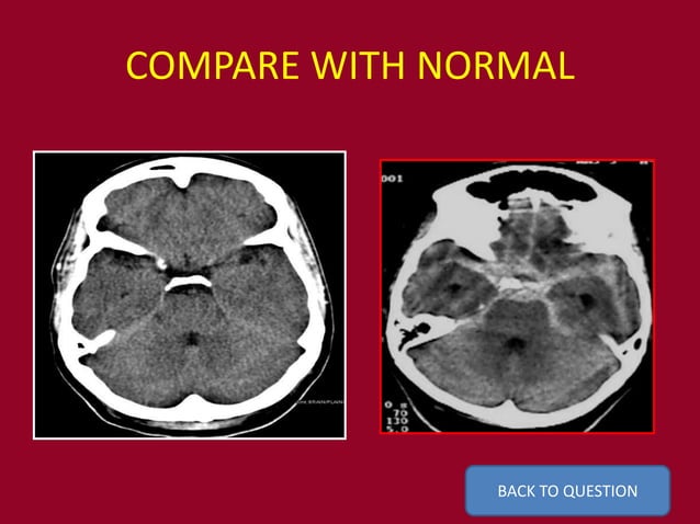 Subarachnoid Hemorrhage - Radiology | PPT