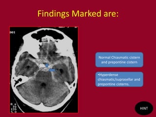 Subarachnoid Hemorrhage - Radiology | PPTX