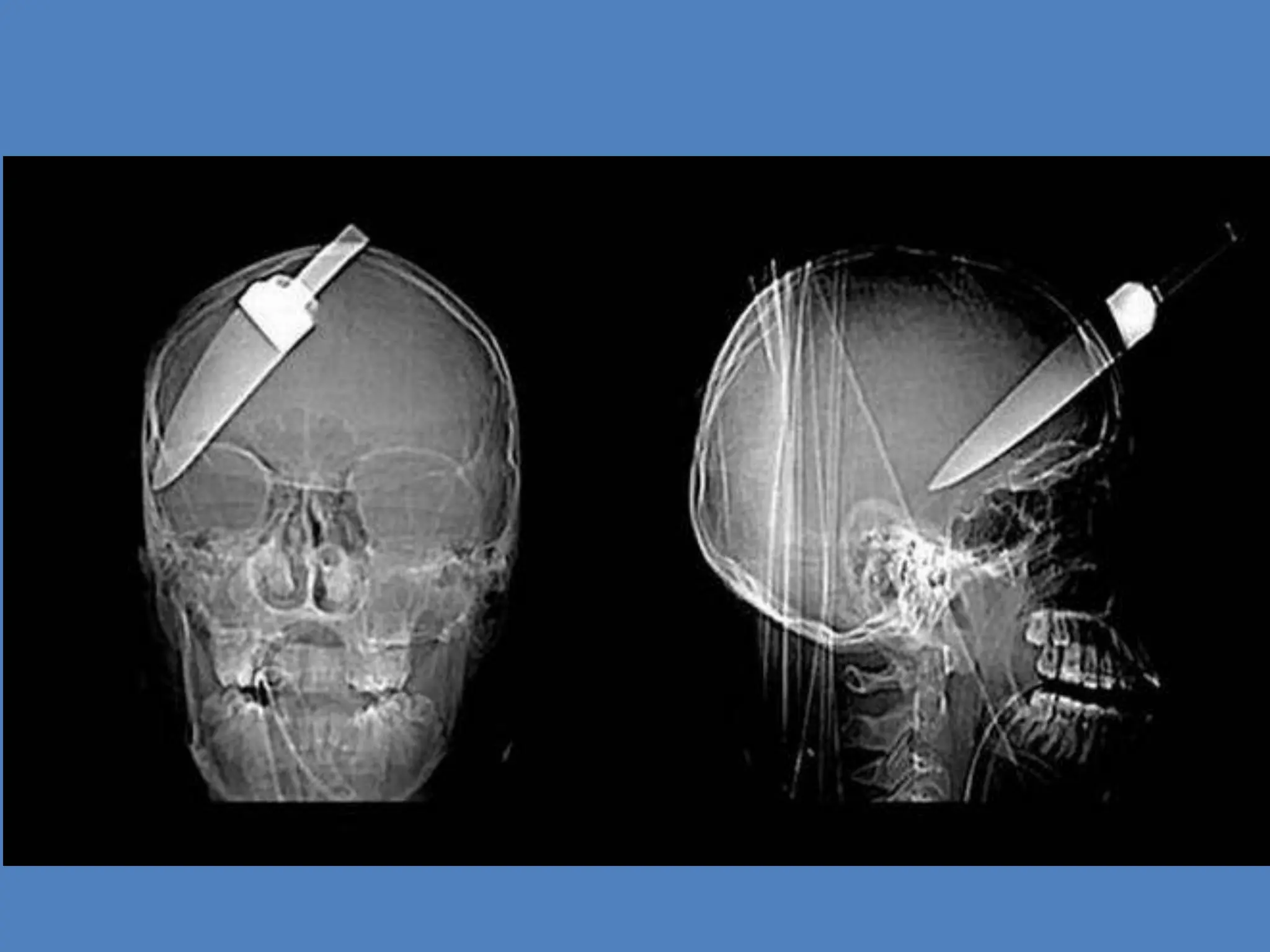 traumatismo craneo encefalico por tomografia computada TAC. | PPTX