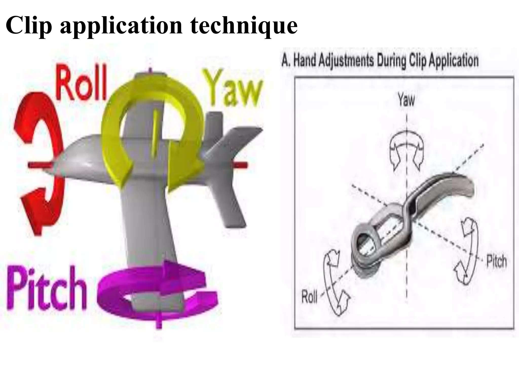 Techiniques of clipping in aneurysm & endovascular option | PPTX