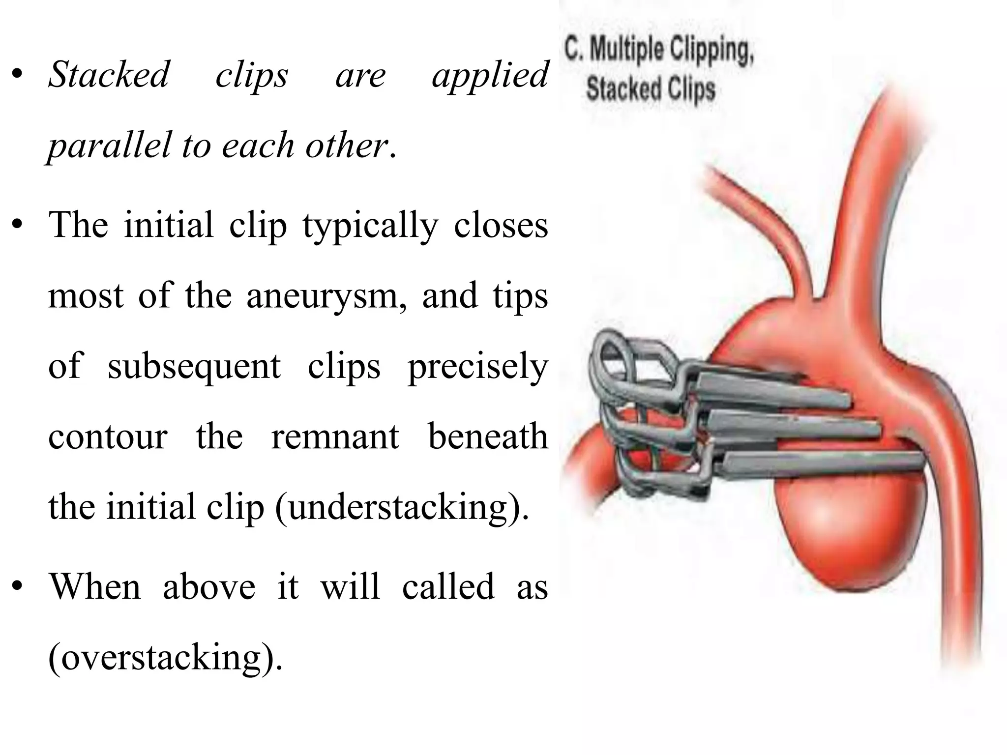 Techiniques of clipping in aneurysm & endovascular option | PPTX