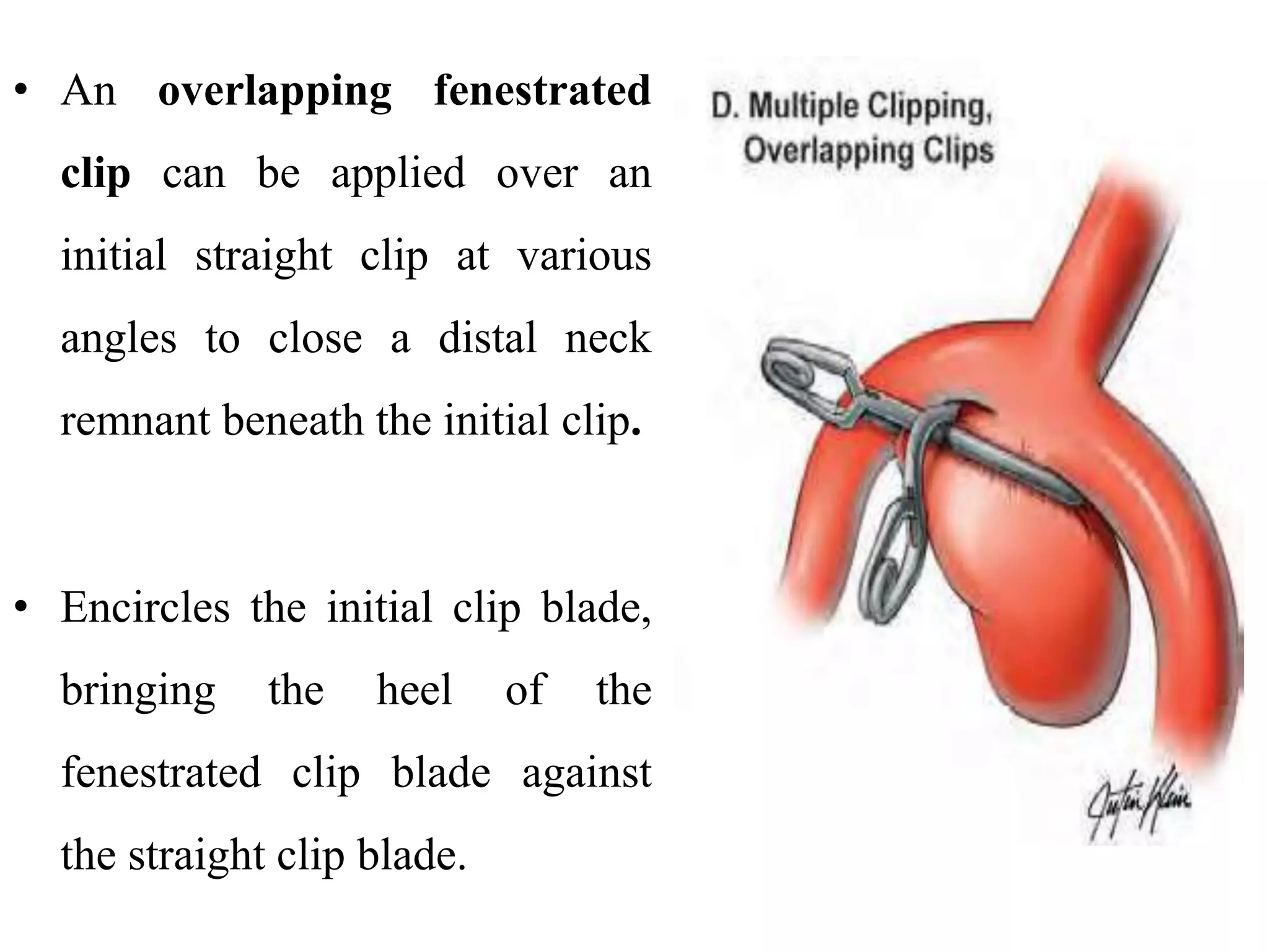 Techiniques of clipping in aneurysm & endovascular option | PPTX
