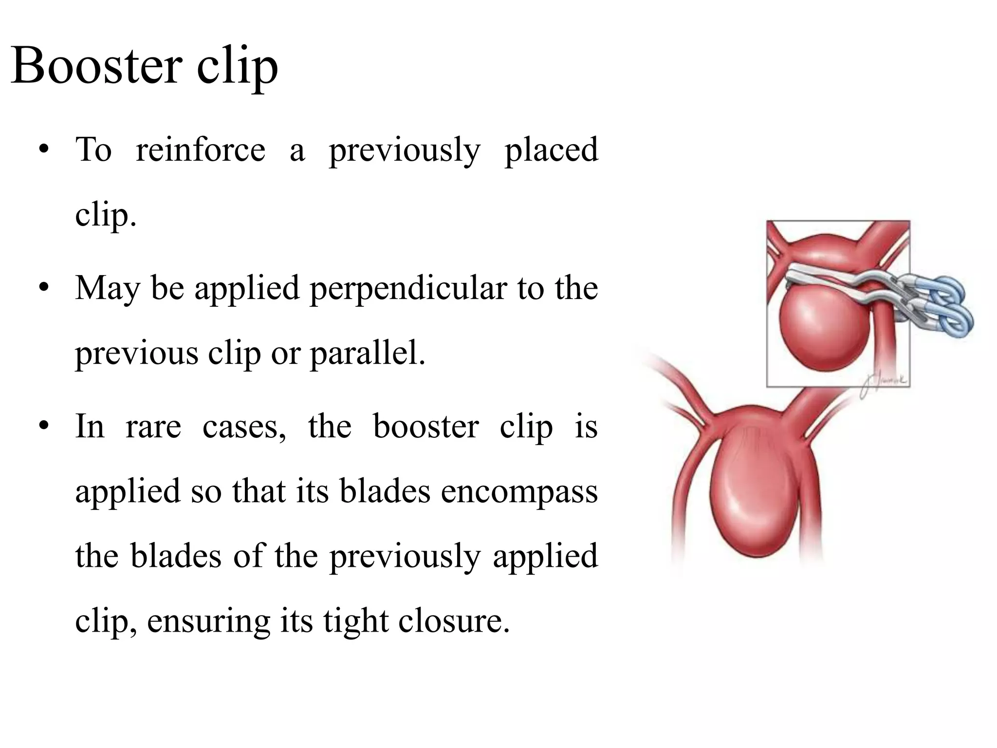 Techiniques of clipping in aneurysm & endovascular option | PPTX