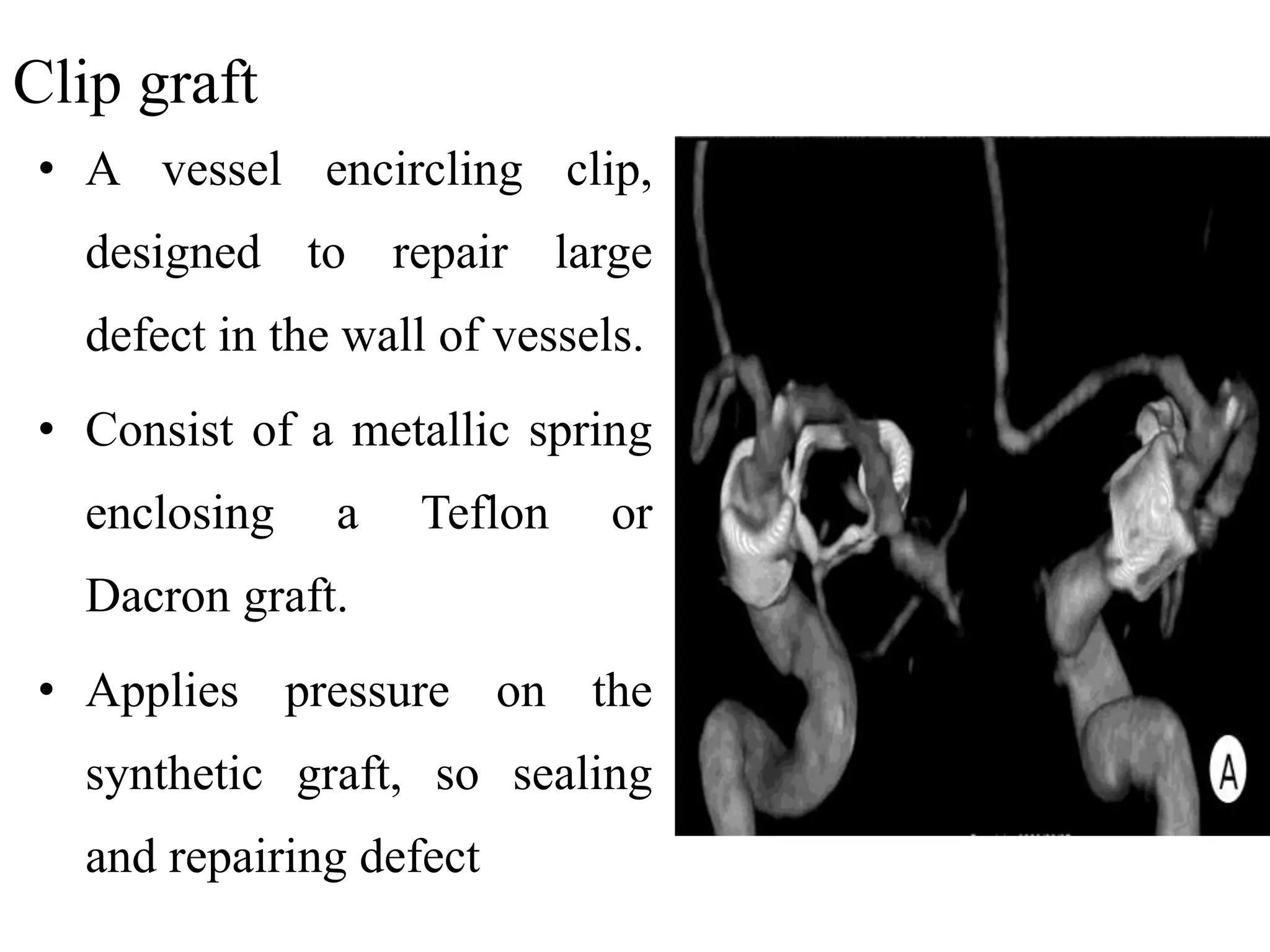 Techiniques of clipping in aneurysm & endovascular option | PPTX