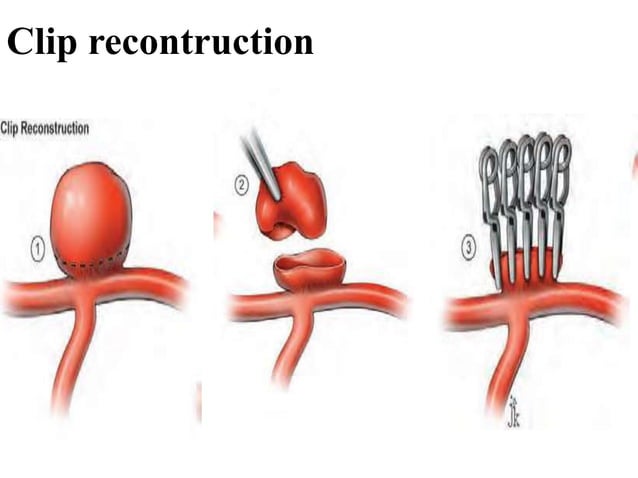 Techiniques of clipping in aneurysm & endovascular option | PPTX ...