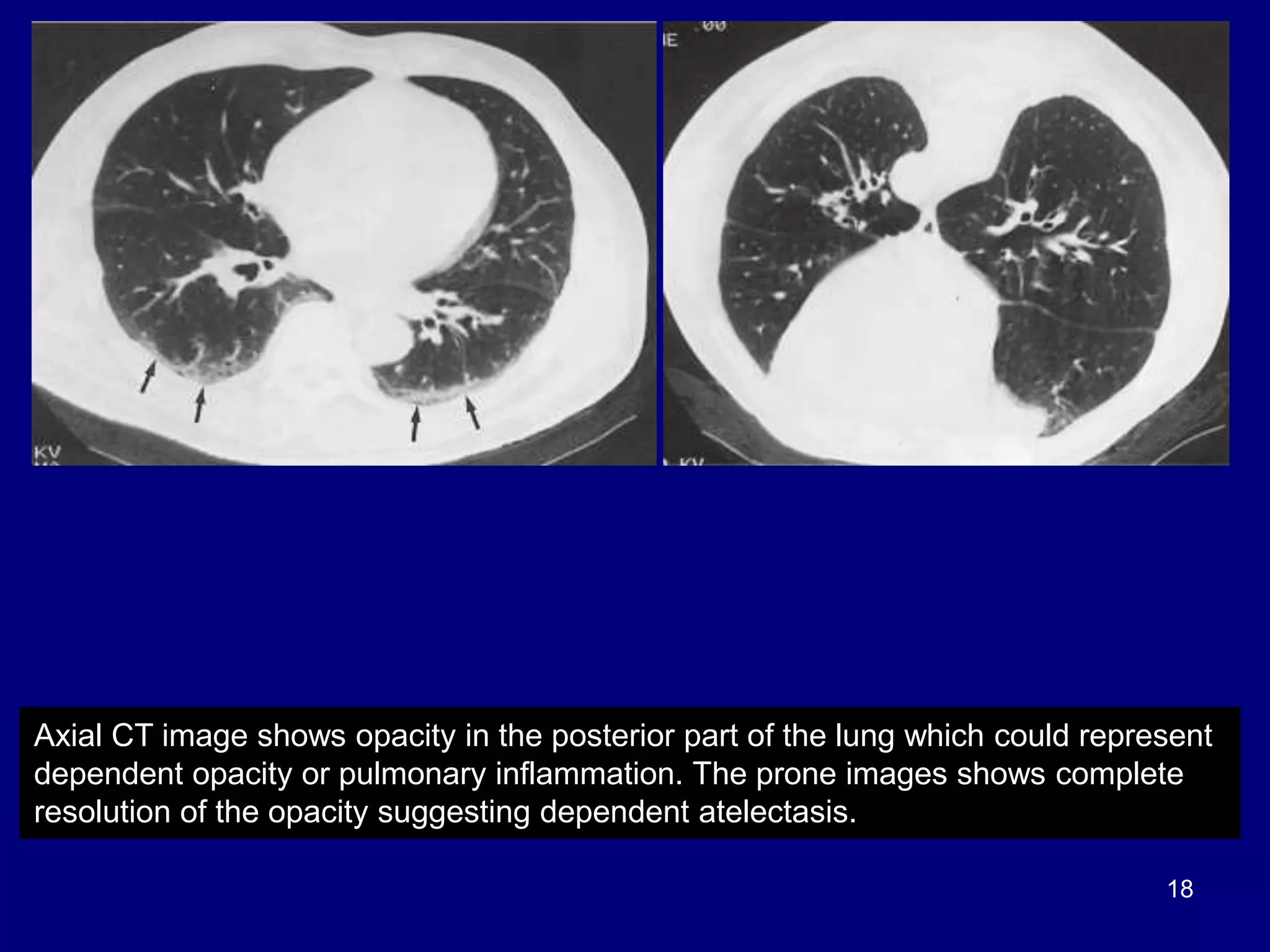 Technical aspect of hrct; normal lung anatomy & hrct findings of lung ...