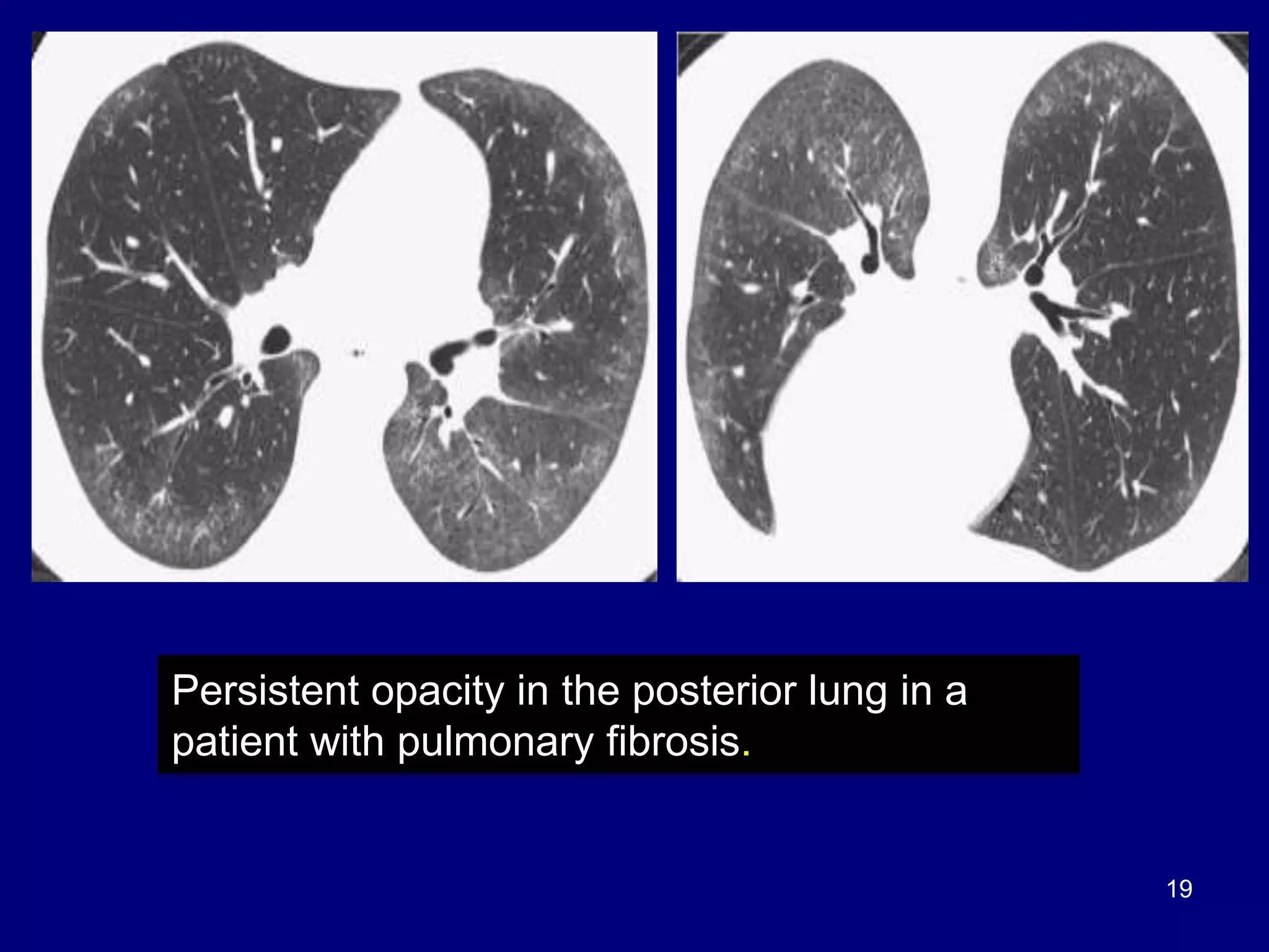 Technical aspect of hrct; normal lung anatomy & hrct findings of lung ...