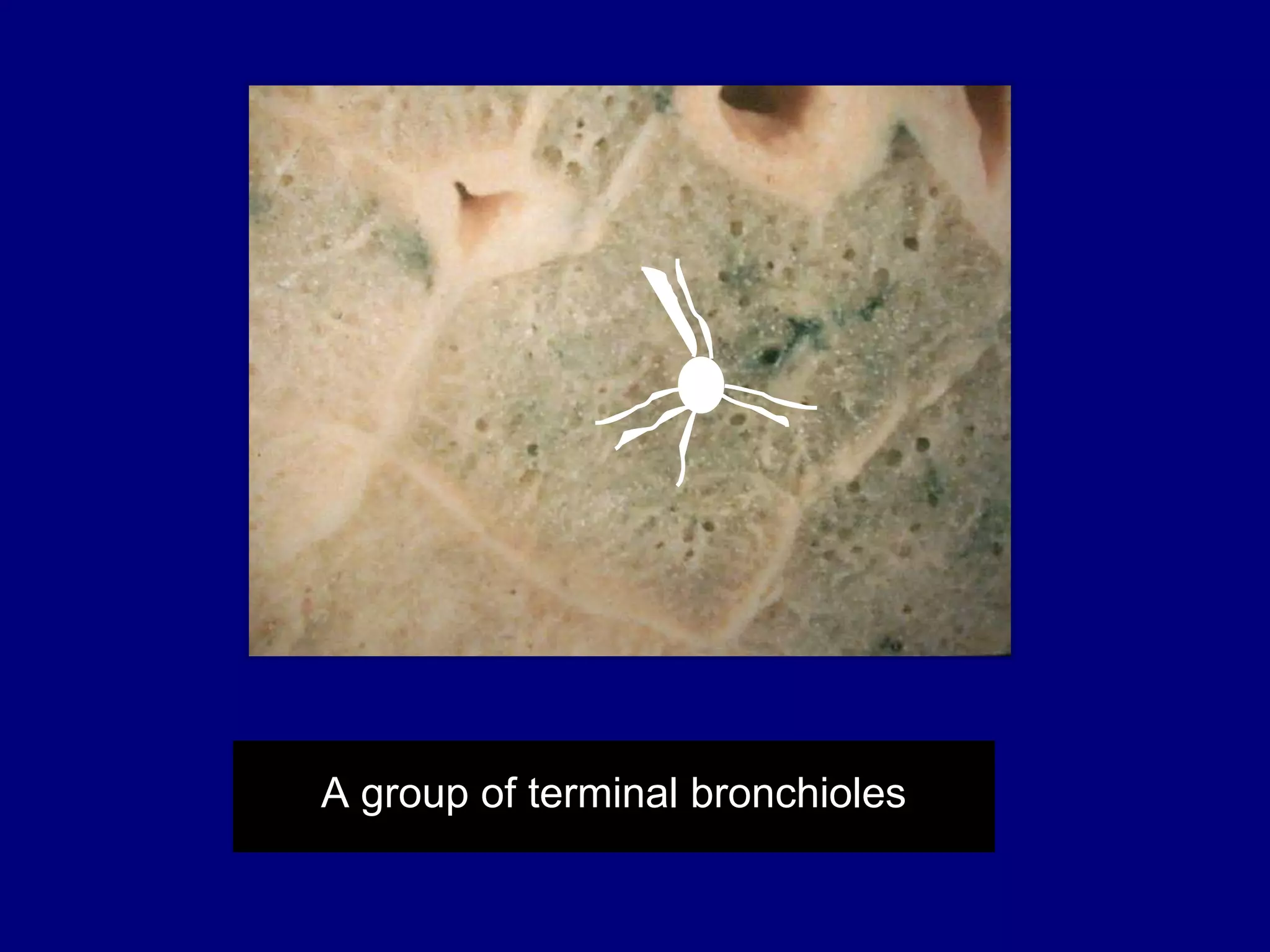 Technical aspect of hrct; normal lung anatomy & hrct findings of lung ...