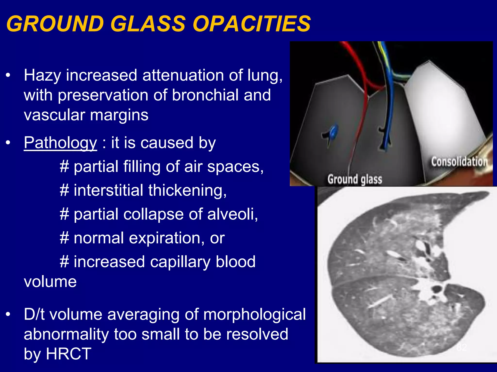 Technical aspect of hrct; normal lung anatomy & hrct findings of lung ...