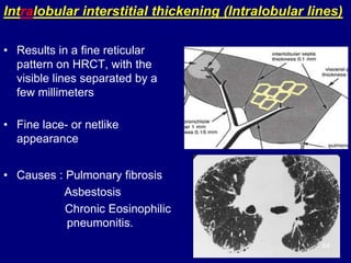 Technical aspect of hrct; normal lung anatomy & hrct findings of lung ...