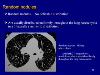 Technical aspect of hrct; normal lung anatomy & hrct findings of lung ...
