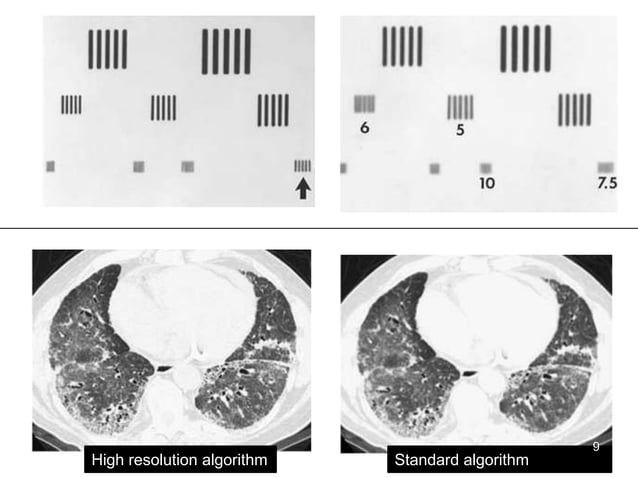 Technical aspect of hrct; normal lung anatomy & hrct findings of lung ...