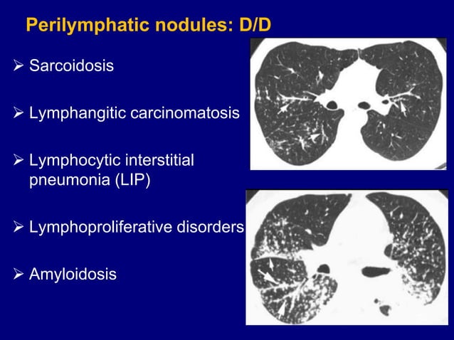 Technical aspect of hrct; normal lung anatomy & hrct findings of lung ...