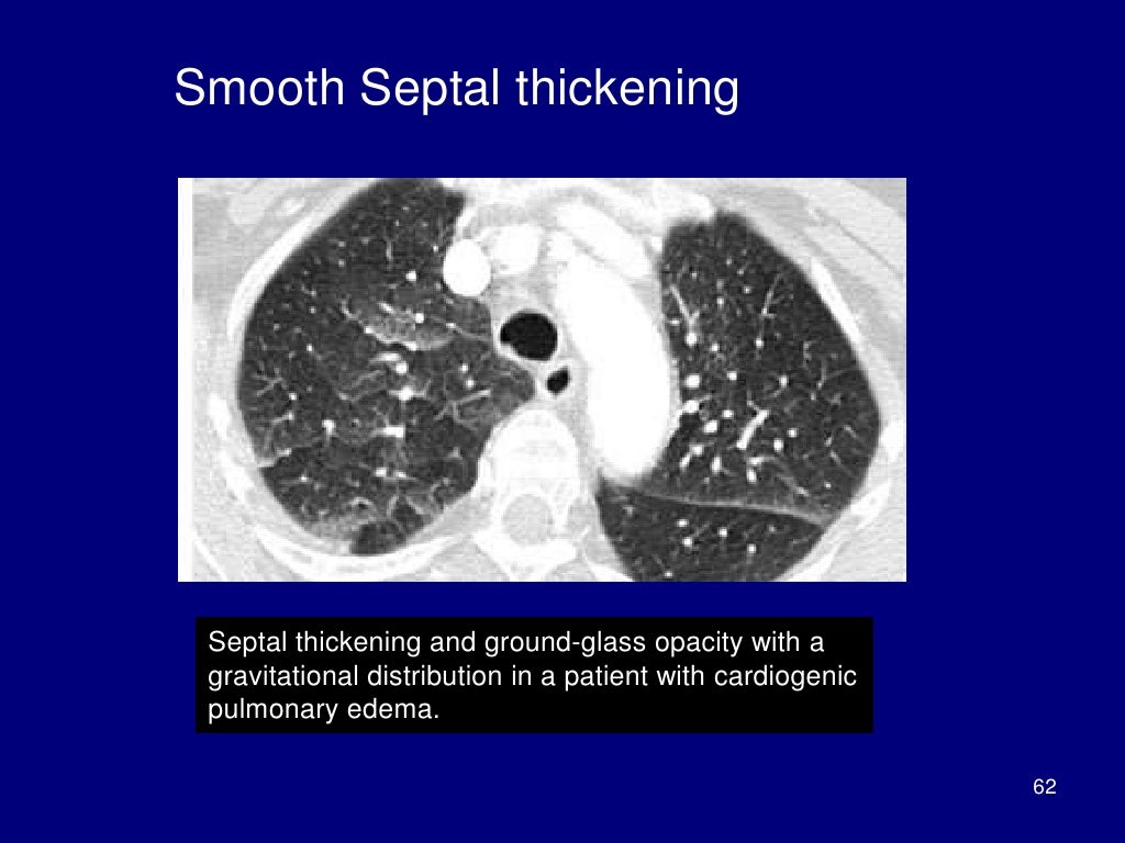 Technical aspect of hrct; normal lung anatomy & hrct findings of lung…