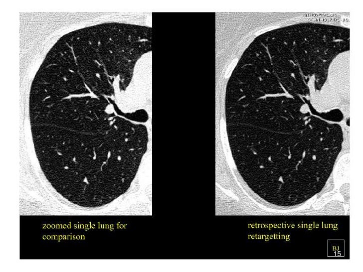 Technical aspect of hrct; normal lung anatomy & hrct findings of lung…