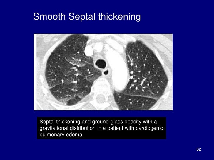 Technical aspect of hrct; normal lung anatomy & hrct findings of lung…