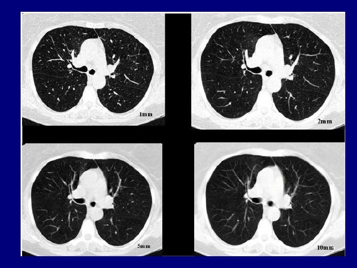Technical aspect of hrct; normal lung anatomy & hrct findings of lung…