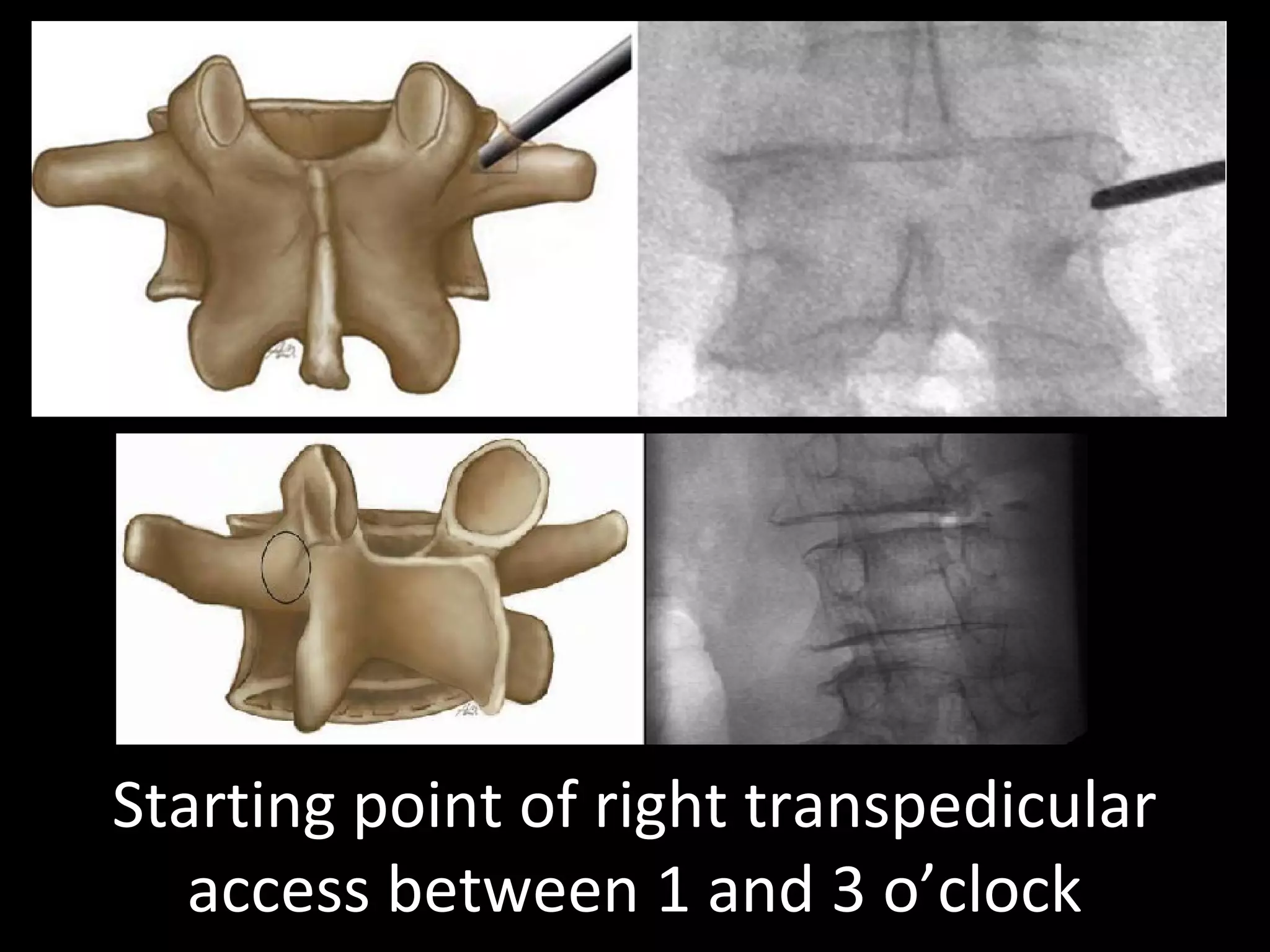 Technical aspects of percutaneous vertebroplasty & kyphoplasty | PPT