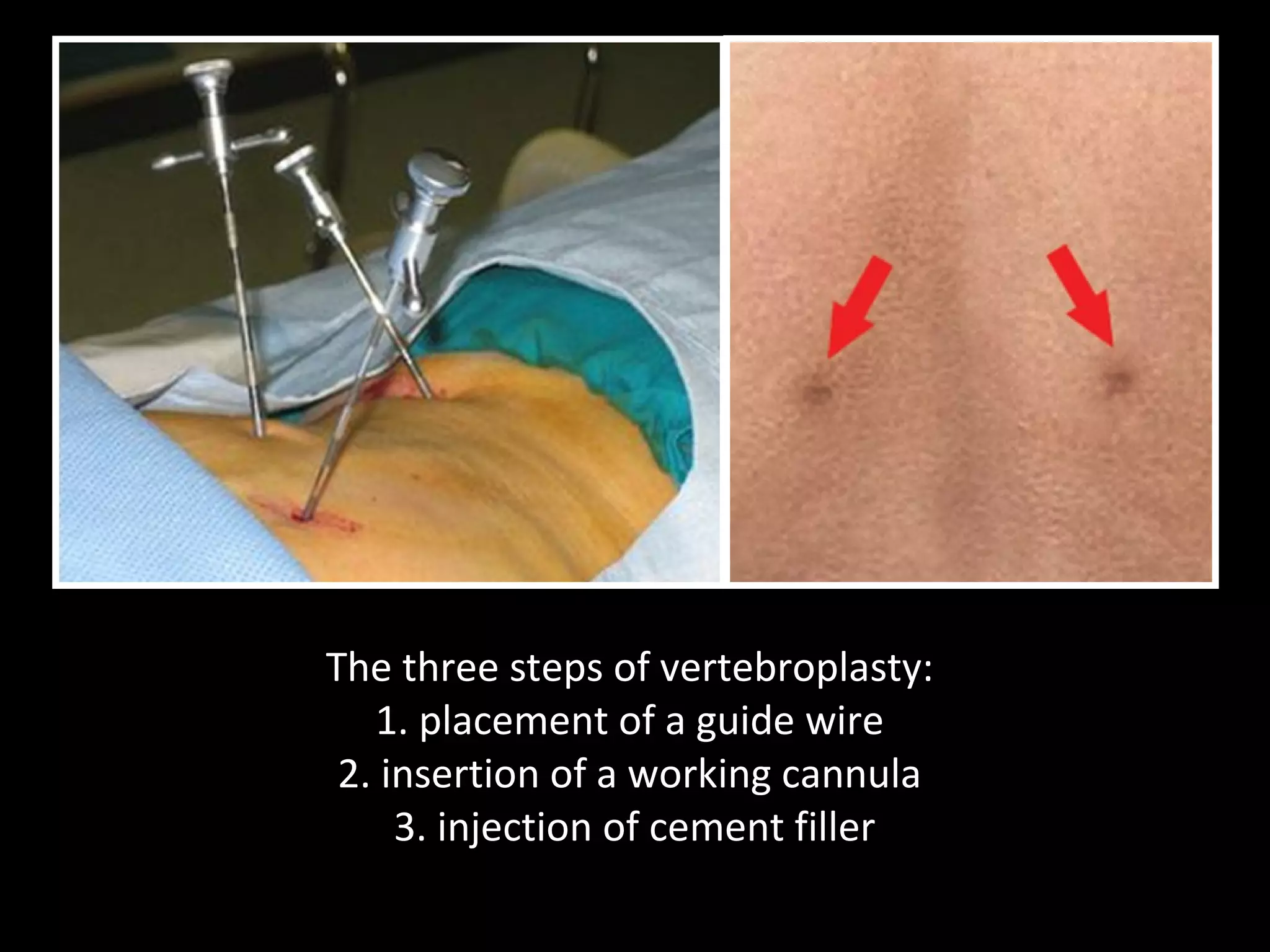 Technical aspects of percutaneous vertebroplasty & kyphoplasty | PPT