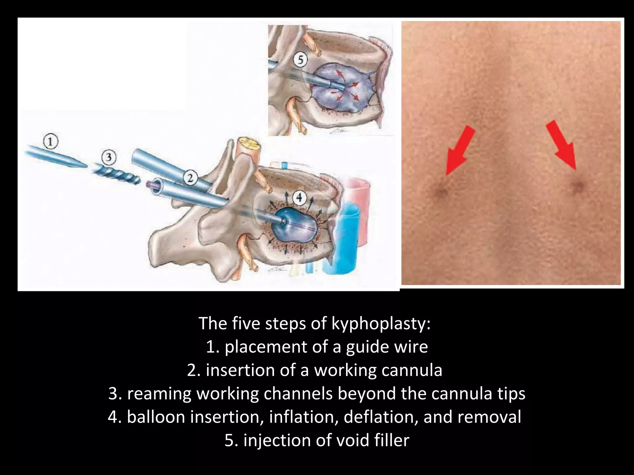 Technical aspects of percutaneous vertebroplasty & kyphoplasty | PPT