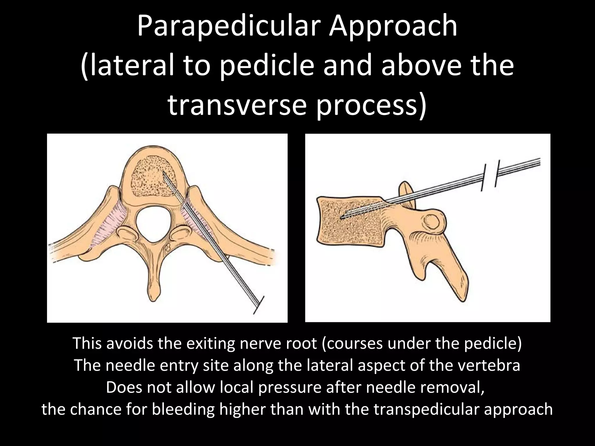 Technical aspects of percutaneous vertebroplasty & kyphoplasty