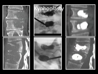 Technical aspects of percutaneous vertebroplasty & kyphoplasty | PPT