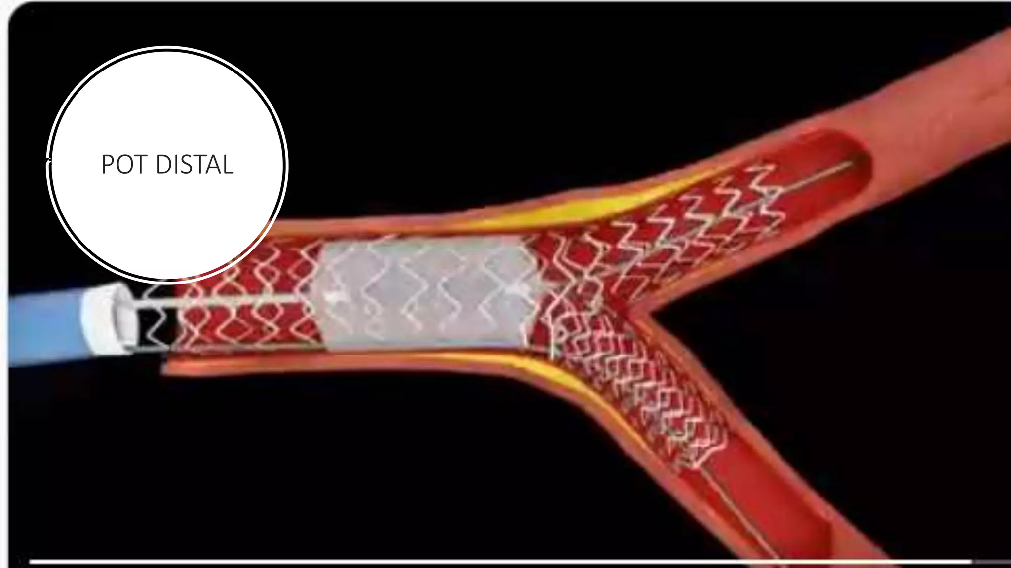 Technical aspects of the t and small protrusion tap | PPTX