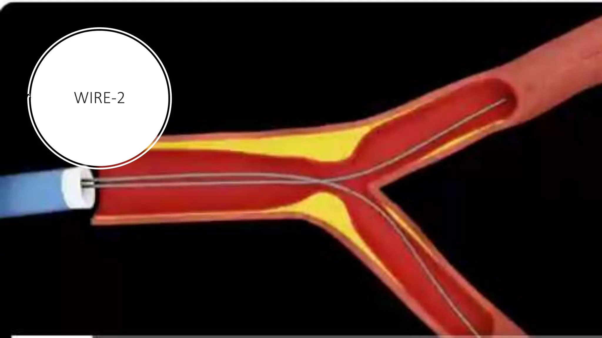Technical aspects of the t and small protrusion tap | PPTX