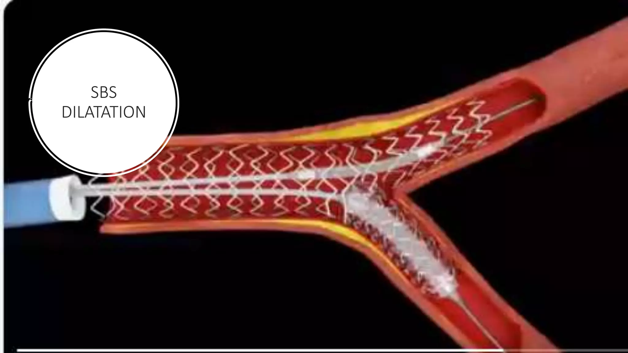 Technical aspects of the t and small protrusion tap | PPTX