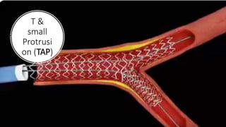 Technical aspects of the t and small protrusion tap | PPTX