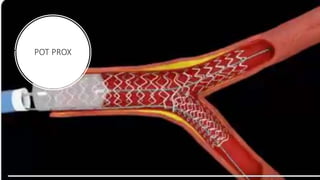 Technical aspects of the t and small protrusion tap | PPTX