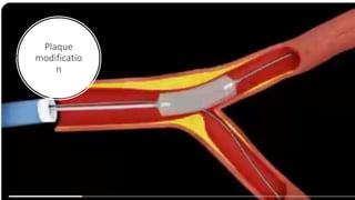 Technical aspects of the t and small protrusion tap | PPTX