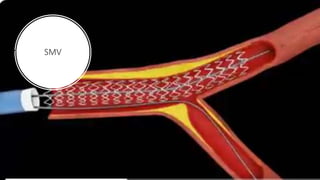 Technical aspects of the t and small protrusion tap | PPTX