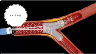Technical aspects of the t and small protrusion tap | PPTX