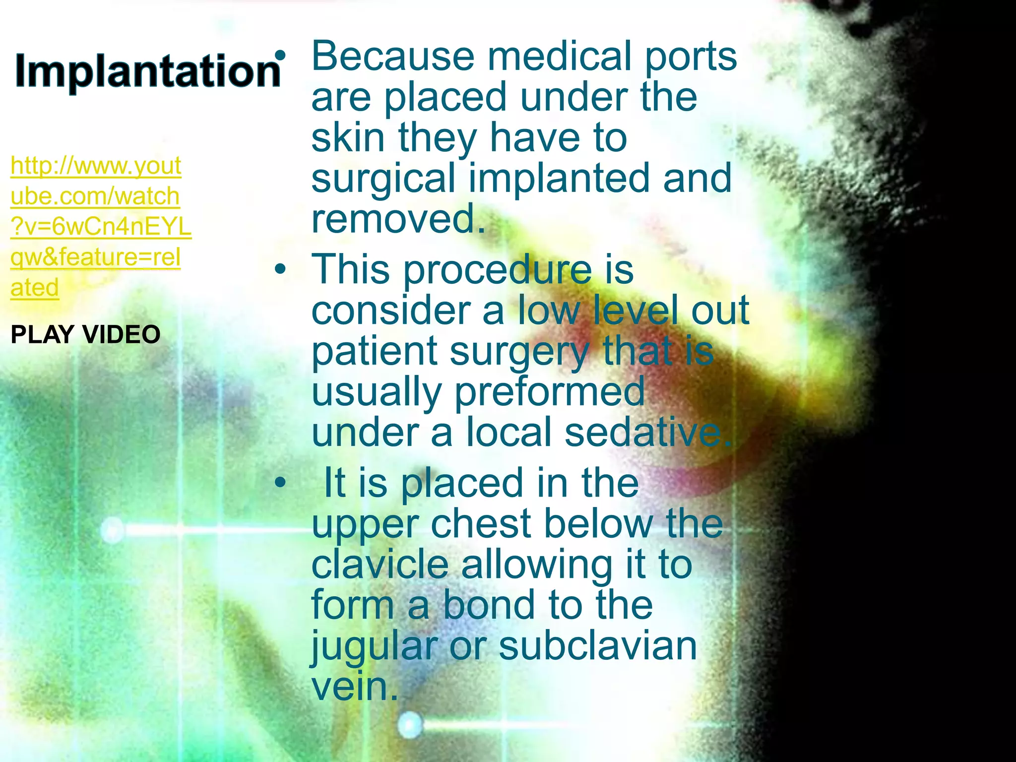 Technical defintion of portacath | PPTX
