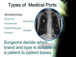 Technical defintion of portacath | PPT