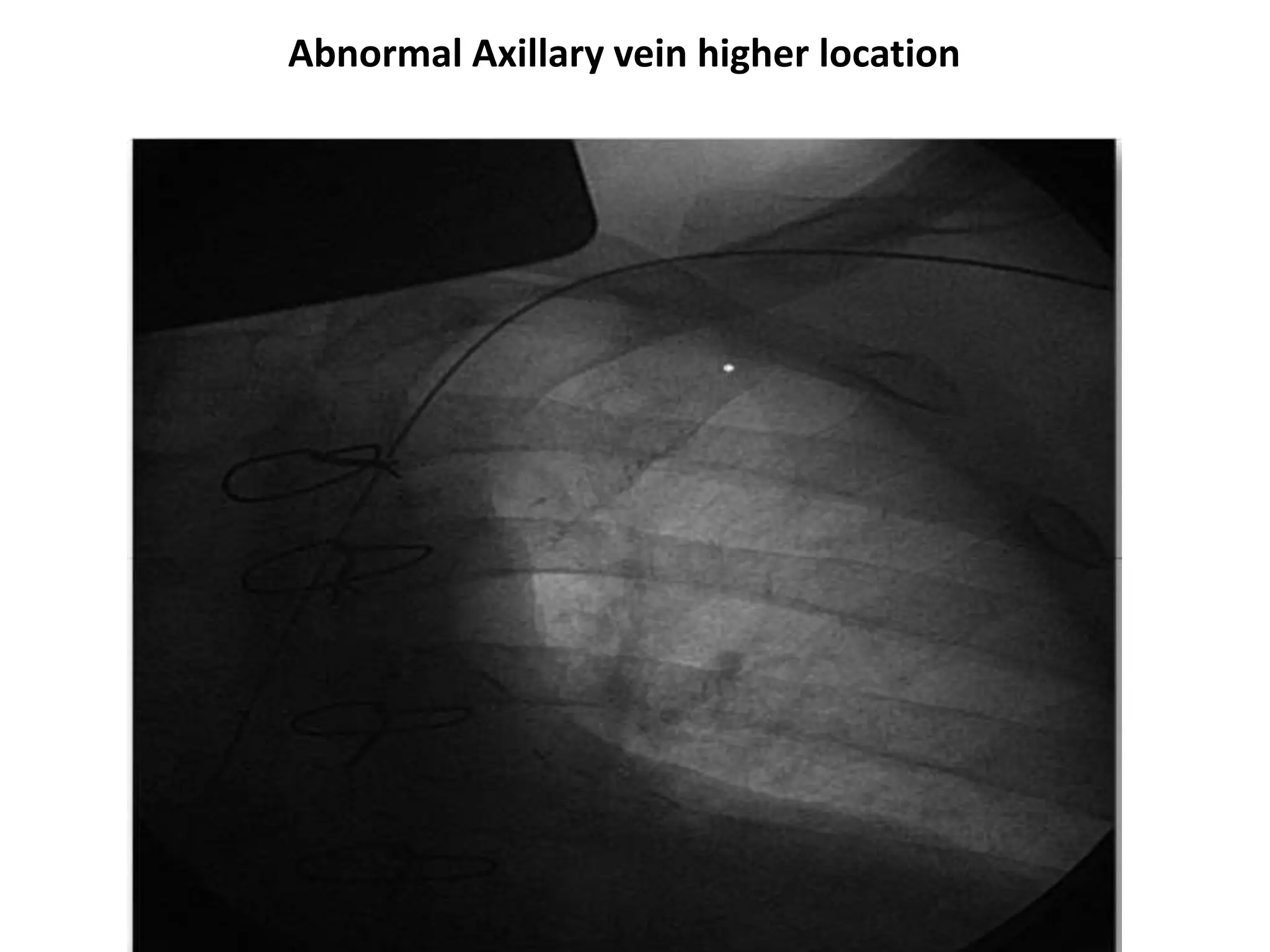 Technic venous access for permanent pacemaker implantation | PPTX
