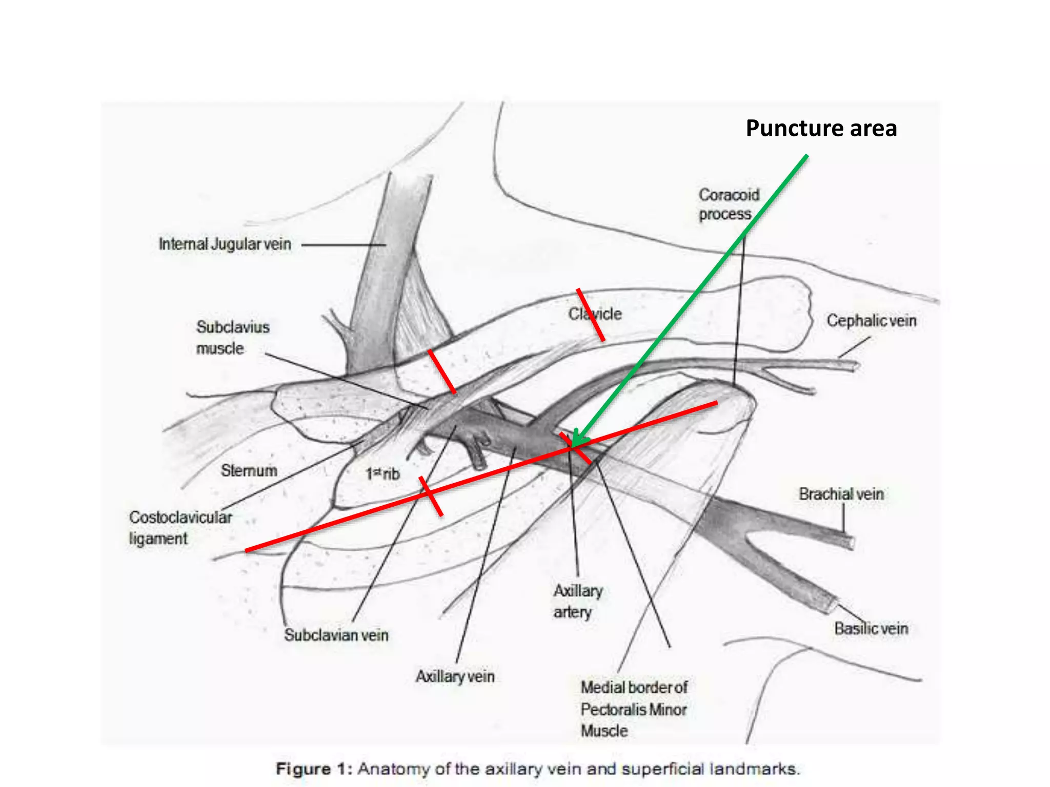 Technic venous access for permanent pacemaker implantation | PPTX
