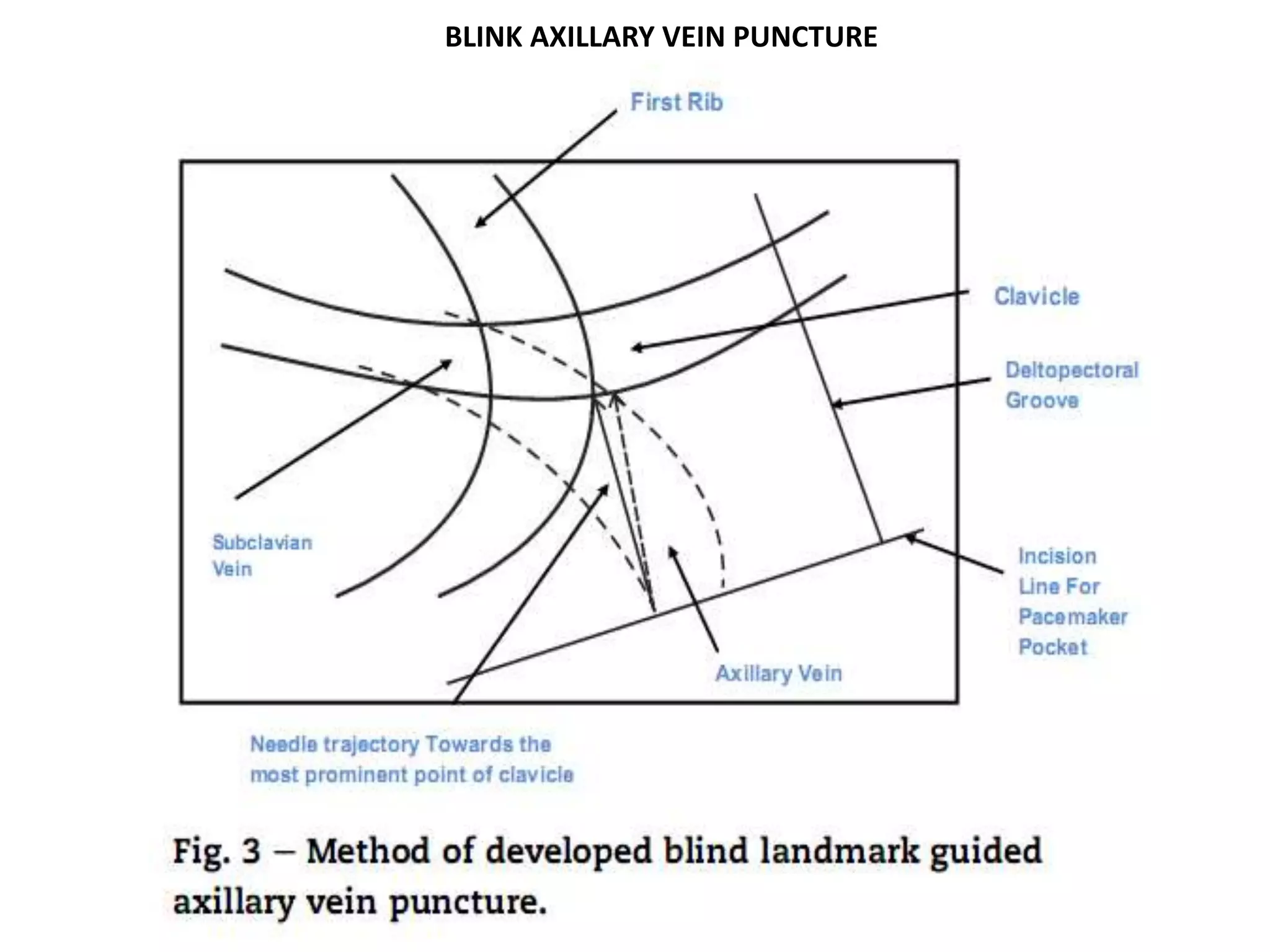 Technic venous access for permanent pacemaker implantation | PPTX