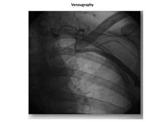 Technic venous access for permanent pacemaker implantation | PPTX