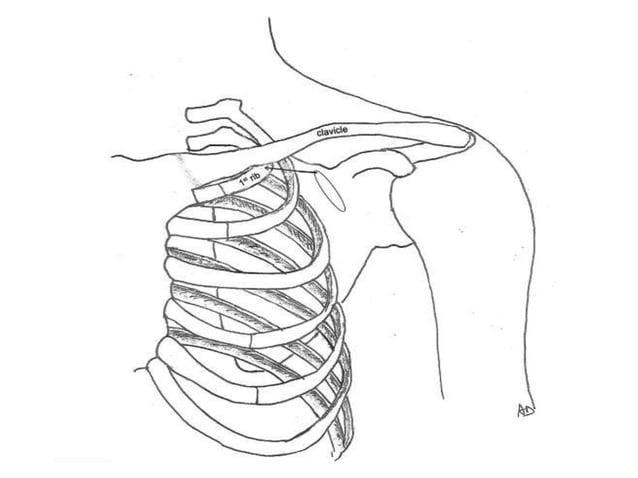 Technic venous access for permanent pacemaker implantation | PPTX